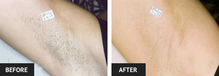 Laser Hair Removal Underarm Before And After
