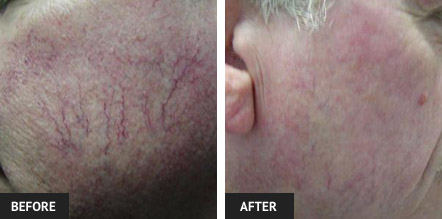 Learn How to Treat Facial Veins | Laser Lipo & Veins