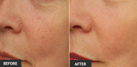How We Treat Telangiectasia with Veinwave | Laser Lipo & Veins