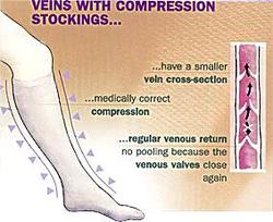 St Louis Arm and Leg Compression Stockings for Spider Veins | Laser ...