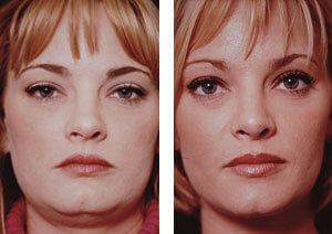 St Louis Chin, Cheek, Jowl, and Jawline Liposuction | Laser Lipo and ...