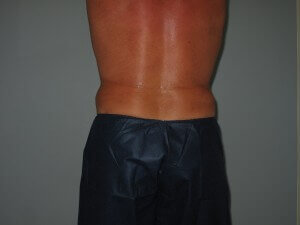 Upper, Lower, and Full Back Liposuction | St Louis | Laser Lipo and ...