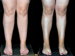 St Louis Calf and Ankle Liposuction | Cost and Procedures | Laser Lipo ...