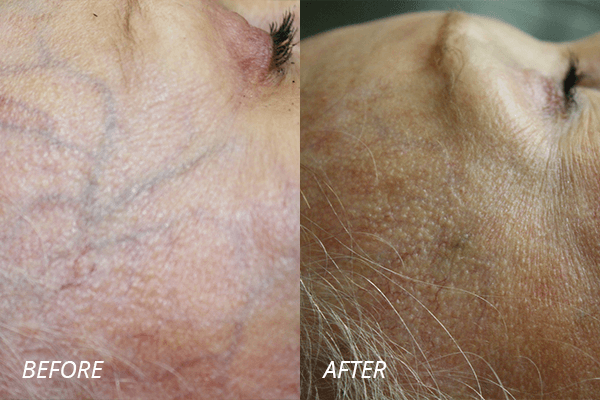 Hand Veins Before and After treatment picture St. Louis