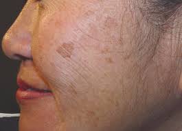 Skin Sun Damage, Birthmarks, and Mole Removal in St. Louis | LLAV