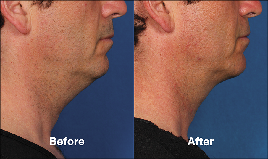 Skinny Lipo Of Neck Of Chin With Laser
