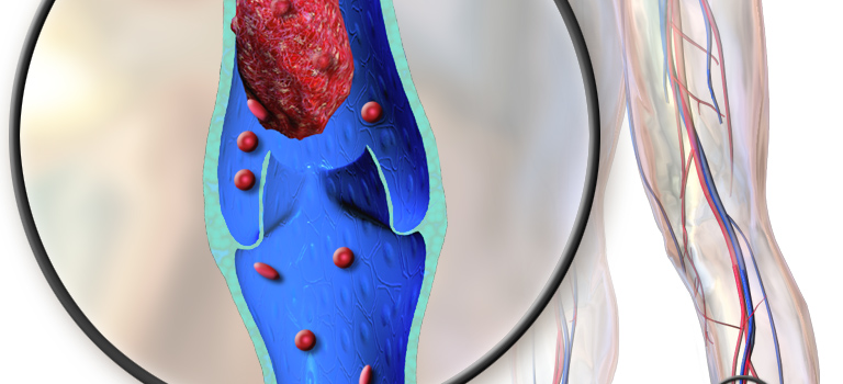 Avoiding DVT | All About the Major Causes of Deep Vein Thrombosis