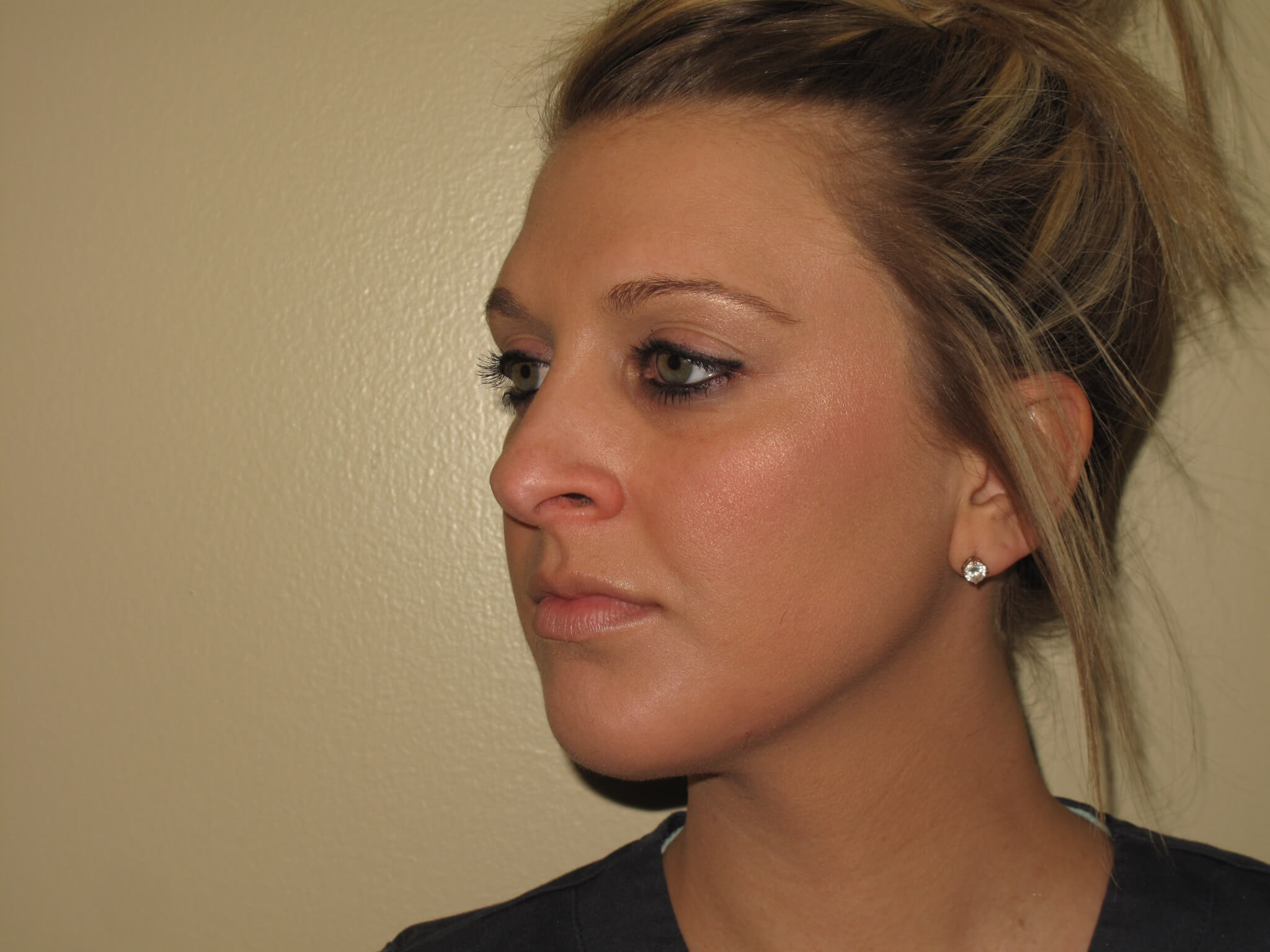 Bellafill Dermal Filler Treatment | Long Lasting Dermal Filler | LLAV
