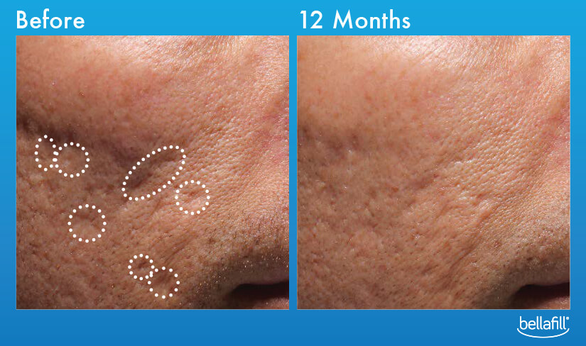 Bellafill Fillers for Acne Scars | Filler Injections | Laser Lipo and Veins