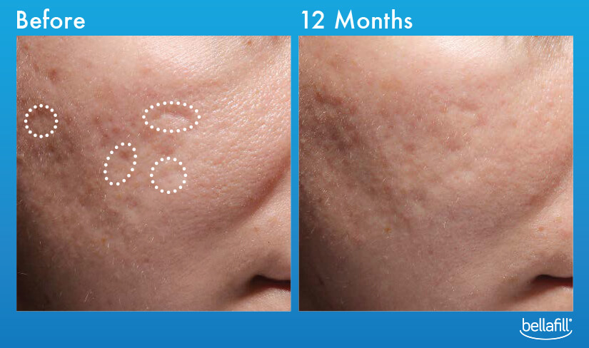 Bellafill Fillers for Acne Scars | Filler Injections | Laser Lipo and Veins