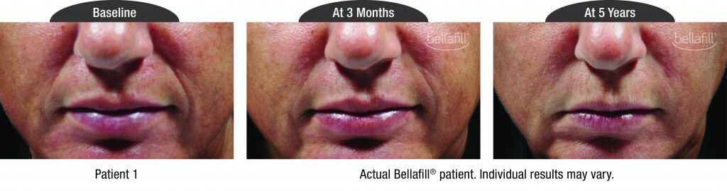 Bellafill Dermal Filler Treatment | Long Lasting Dermal Filler | LLAV