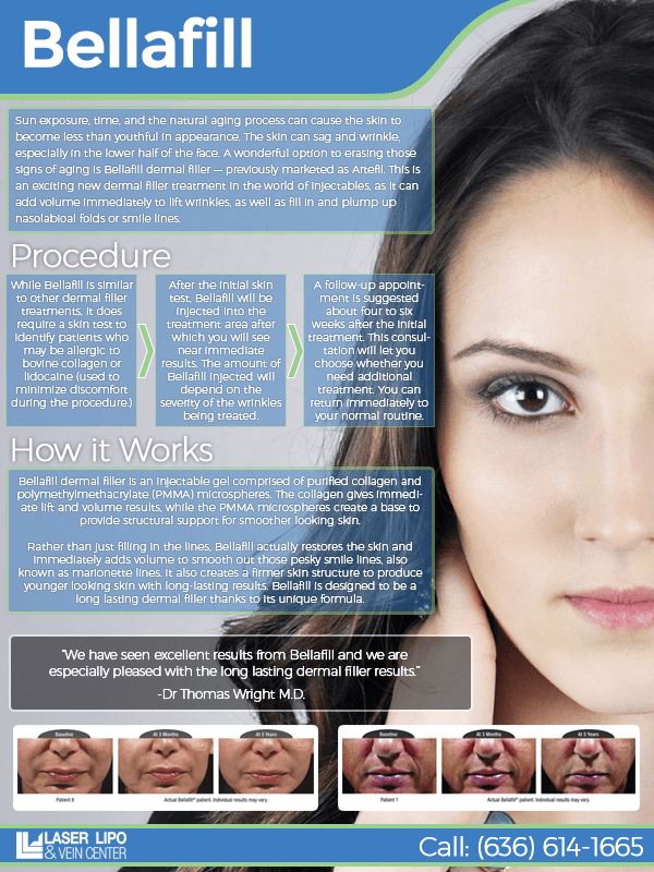 Bellafill Dermal Filler Treatment | Long Lasting Dermal Filler | LLAV