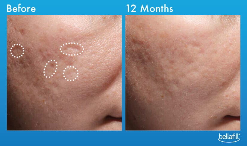 Bellafill Dermal Fillers for Acne Scars | Dermal Filler Injections | LLAV