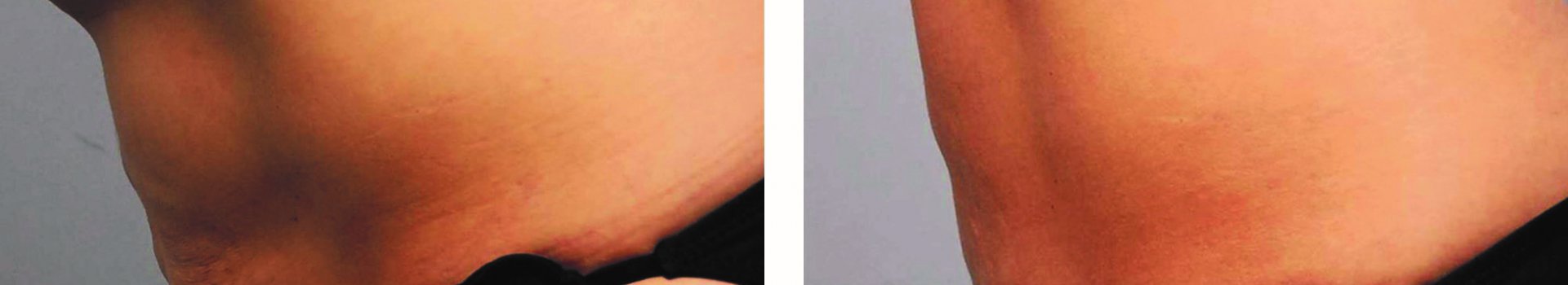 Find Out the Many Benefits of BodyTite | Laser Lipo & Vein Center