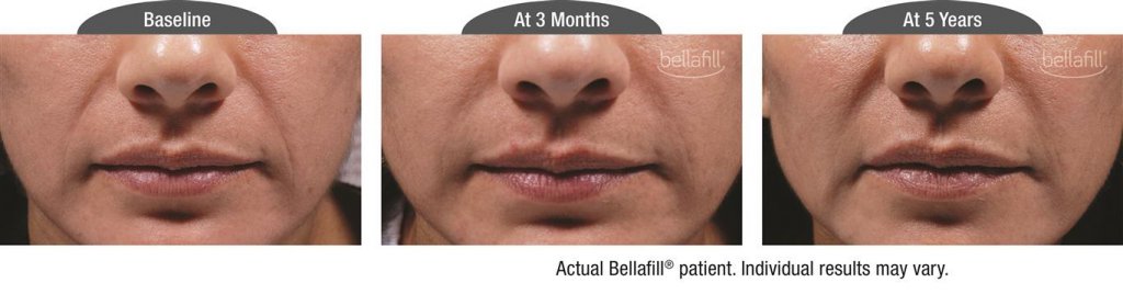 Bellafill Fillers for Acne Scars | Filler Injections | Laser Lipo and Veins