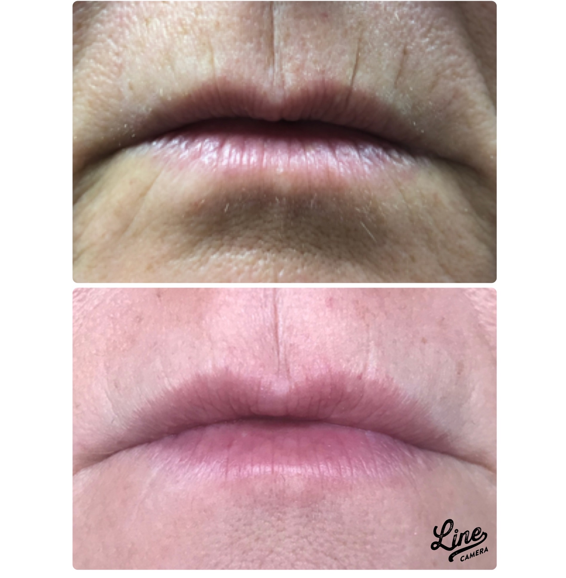 Learn What Type of Lip Fillers are Best for You | Laser Lipo and Veins