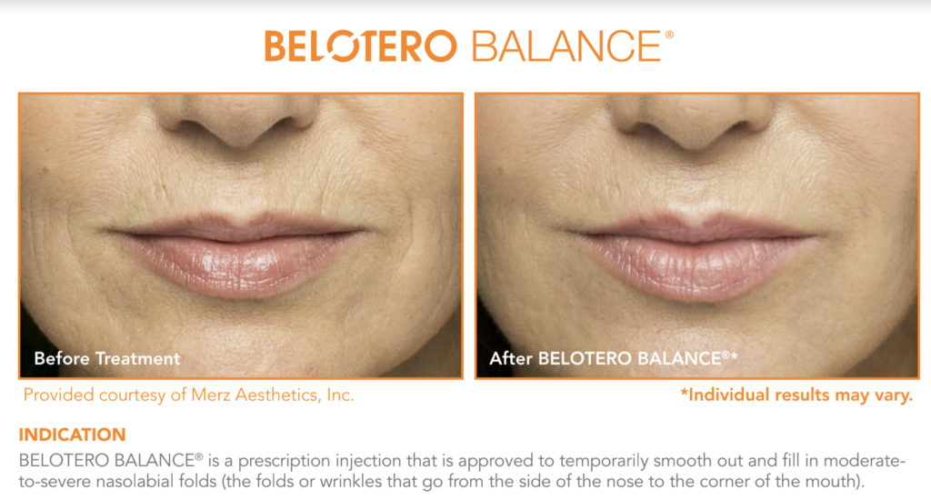 Belotero Dermal Fillers | Improve Wrinkles and Tighten Saggy Skin | LLAV