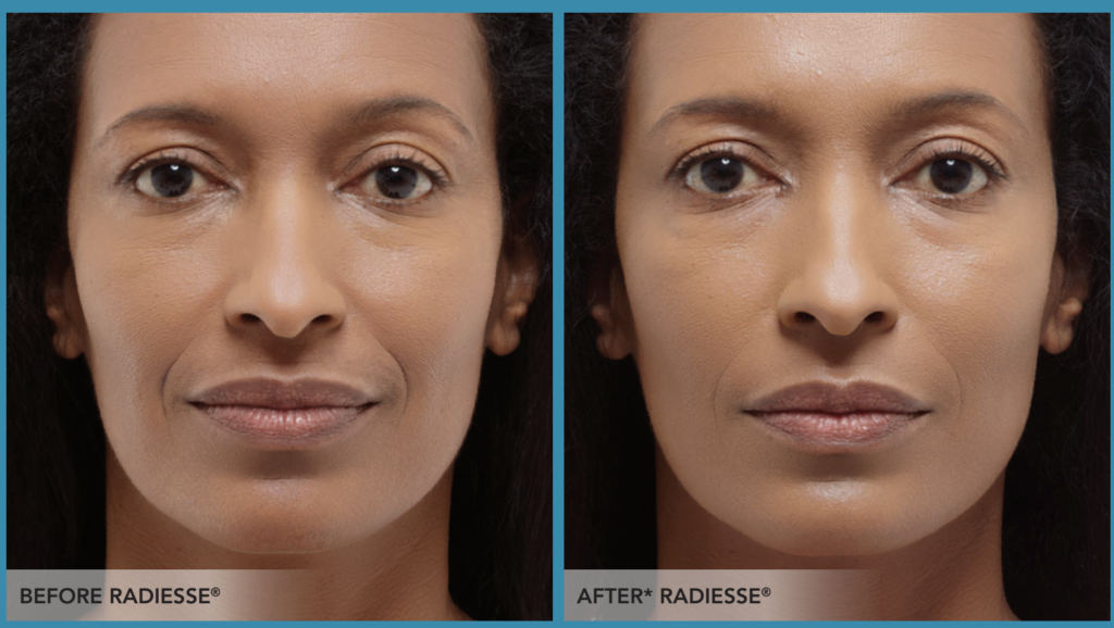Radiesse Dermal, Face, and Lip Fillers | St Louis Laser Lipo & Vein Center