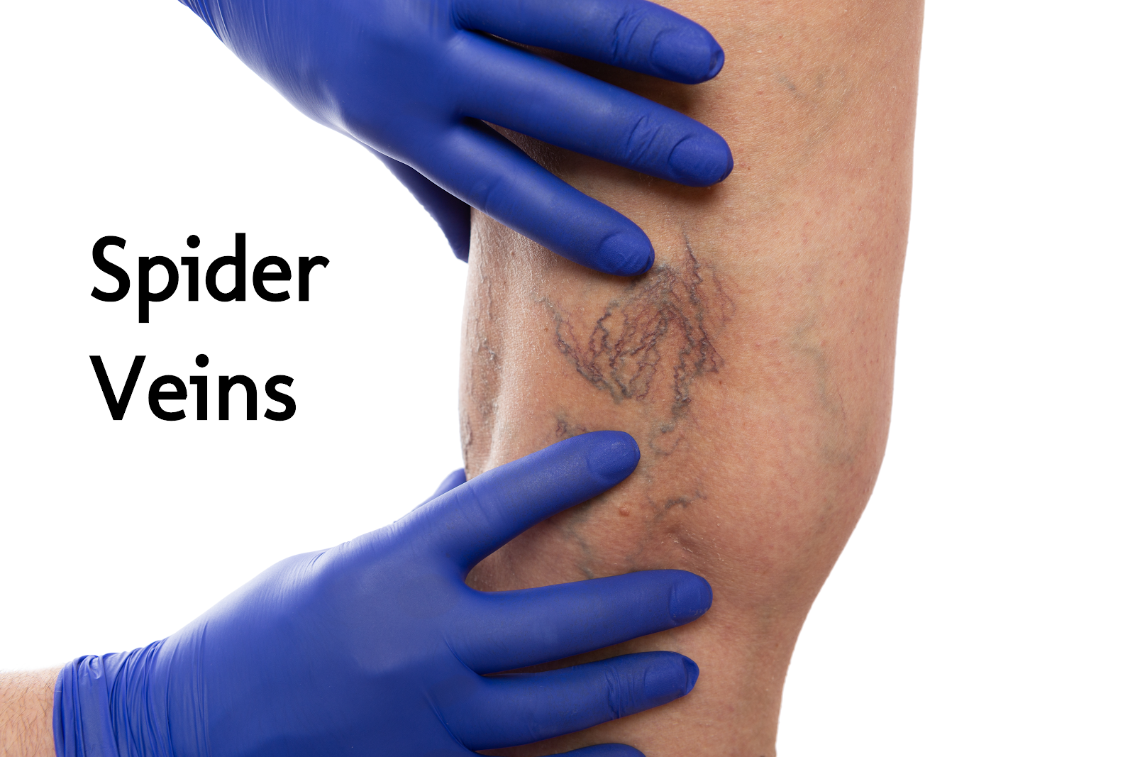 8 Things You Never Knew About Your Veins | Sclerotherapy Vein Treatment ...