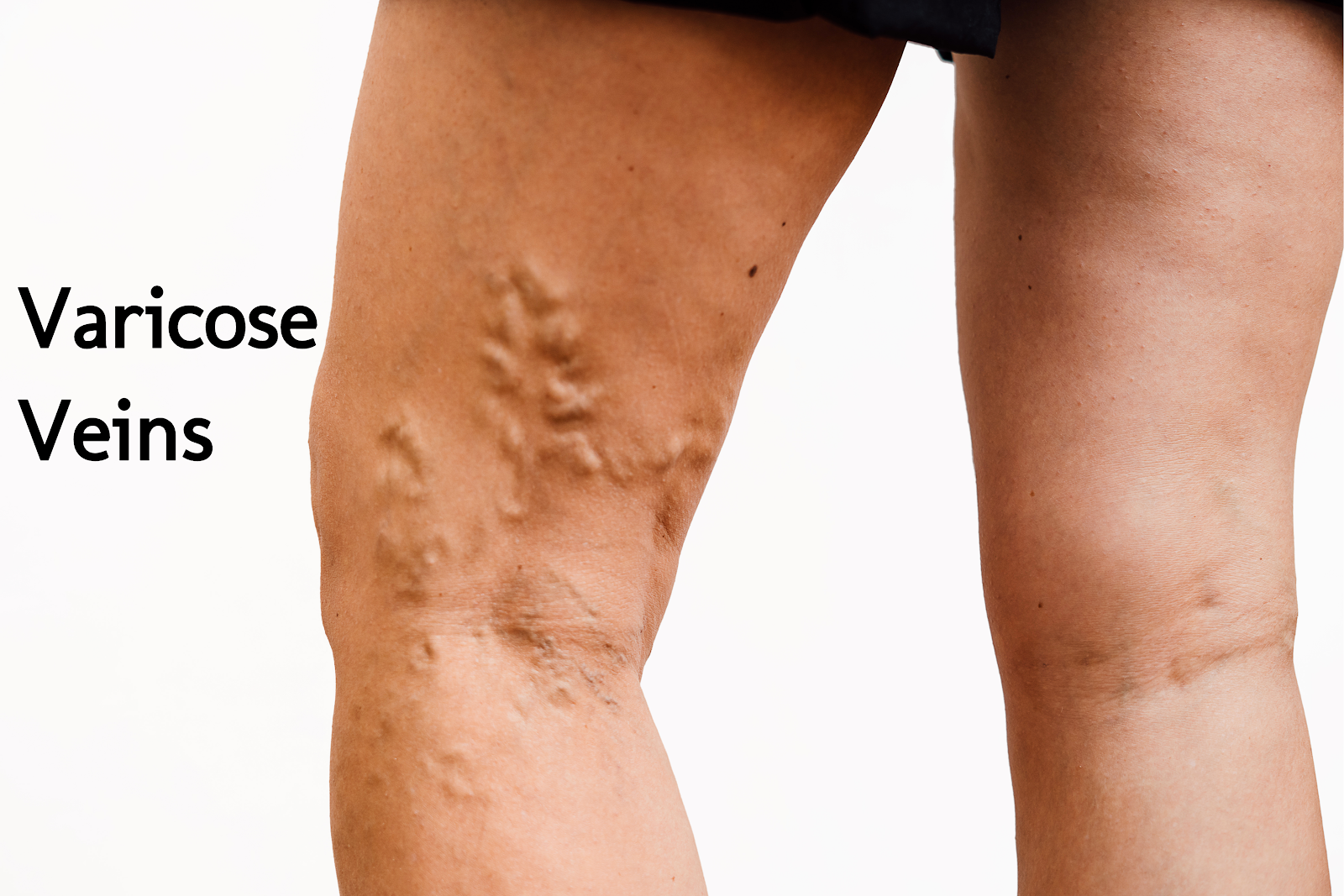 6 Vein Facts & How Sclerotherapy Treatment Can Help | Laser Lipo & Vein ...