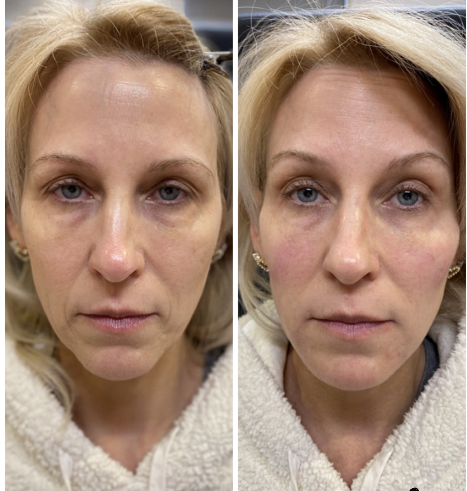 Treat Your Angry or Sad Face with Face Injections | Laser Lipo and Veins