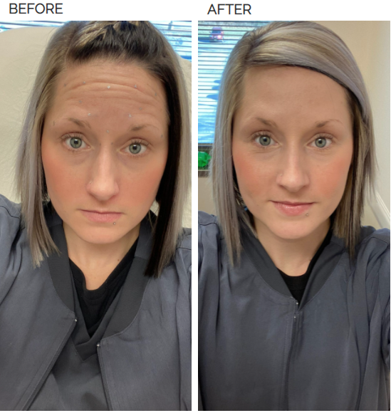 Treat Your Angry or Sad Face with Face Injections | Laser Lipo and Veins