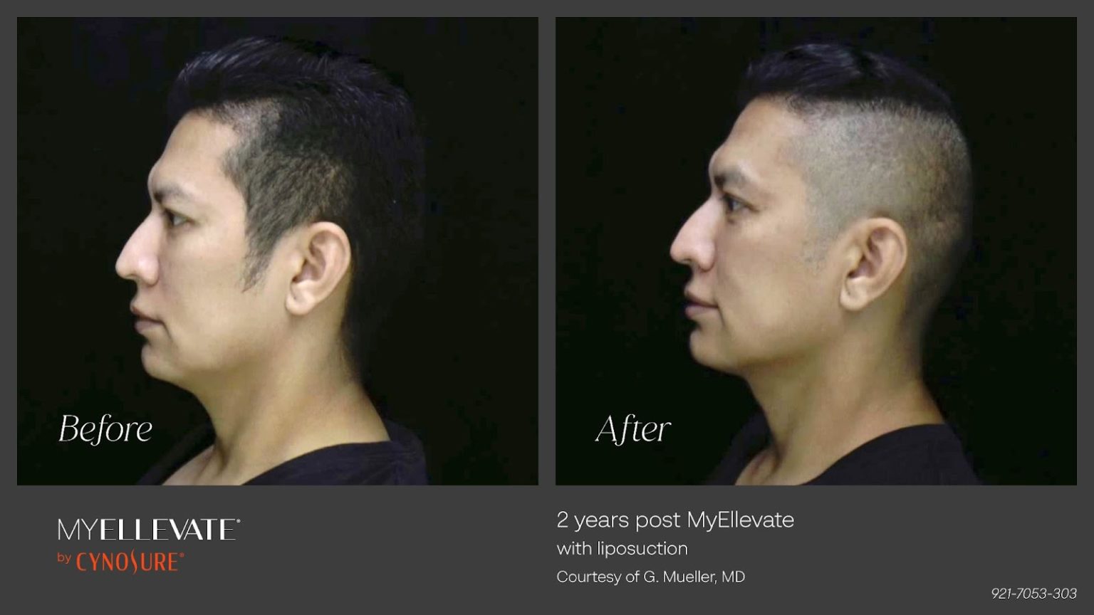 Ditch Zoom Face Filters After MyEllevate Treatment - Laser Lipo