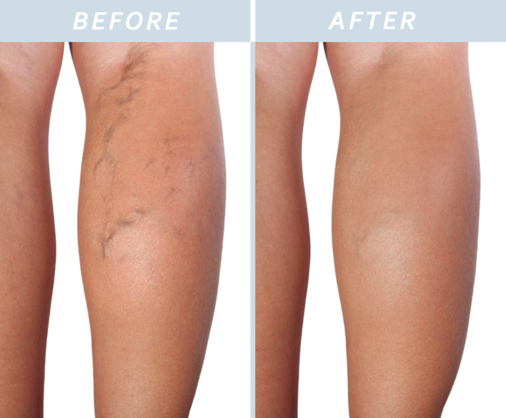 Learn About Sclerotherapy and its Benefits | Laser Lipo and Vein Center