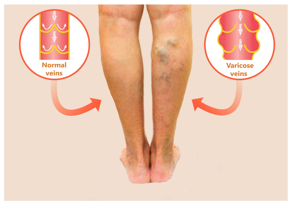 Learn About Sclerotherapy and its Benefits | Laser Lipo and Vein Center