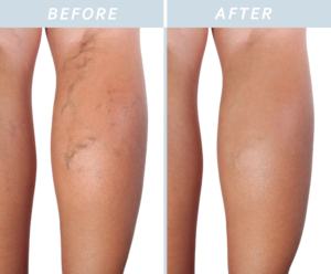 Learn About Sclerotherapy and its Benefits | Laser Lipo and Vein Center