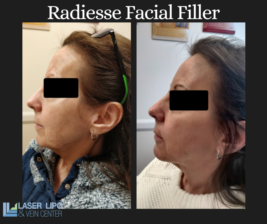 Voluminous Facial Filler Best Laugh Line Filler In NJ | Kessel