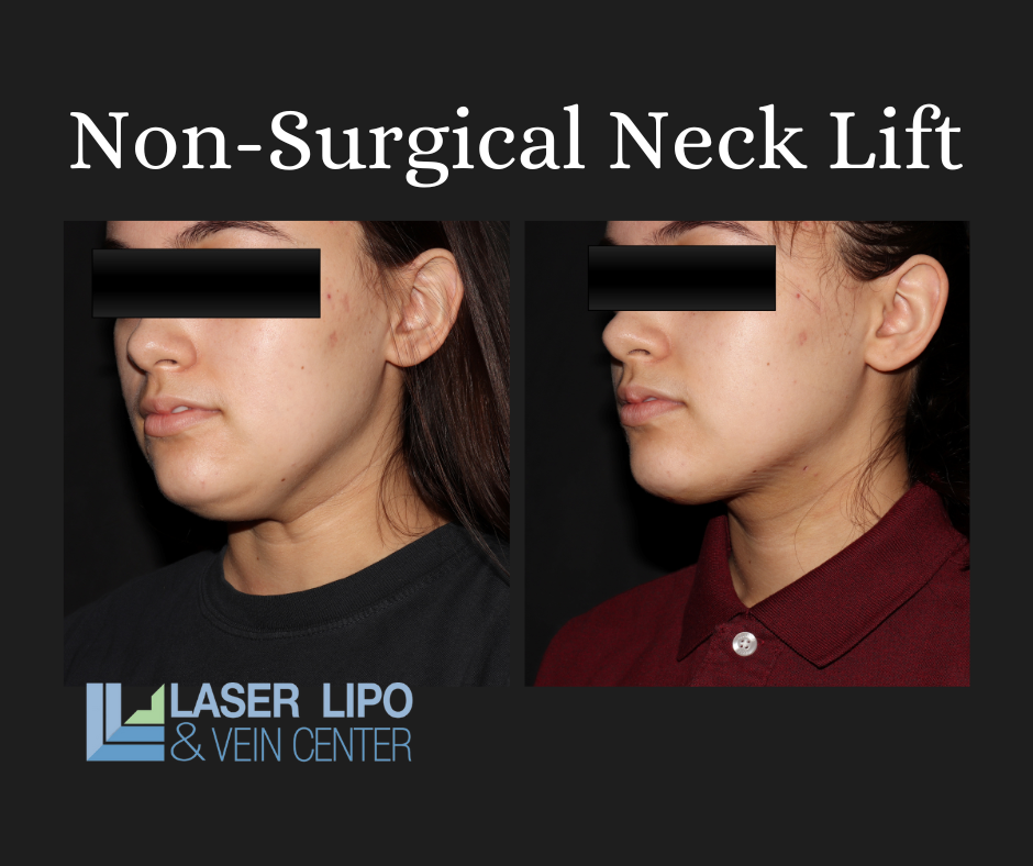 Check Out an Unbelievable Neck Lift Transformation | Laser Lipo and ...