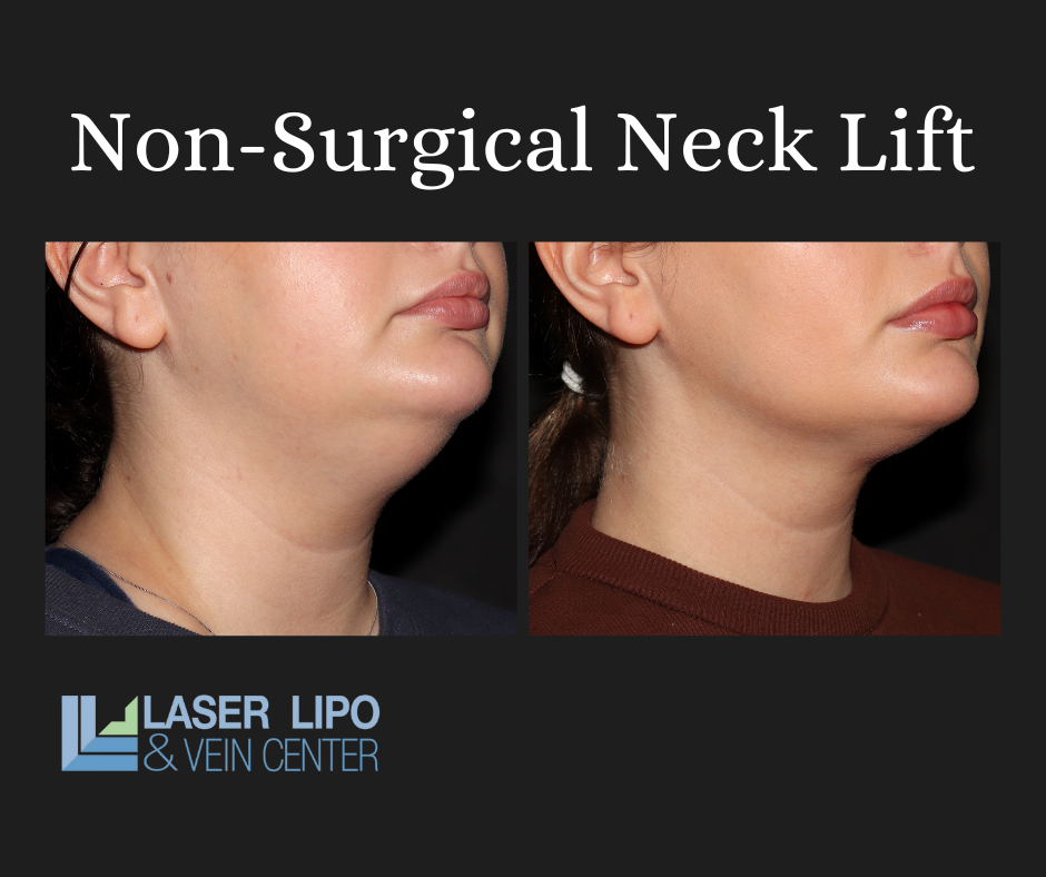 Check Out an Unbelievable Neck Lift Transformation | Laser Lipo and ...