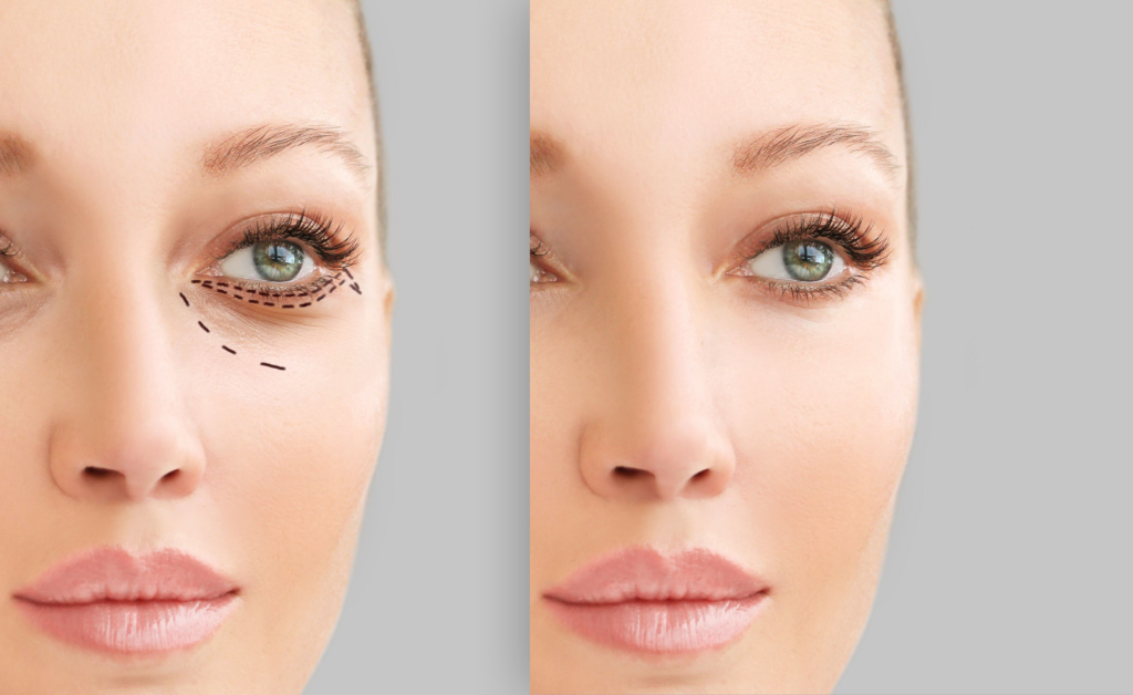 Fat Grafting for Facial Rejuvenation | Laser Lipo and Veins