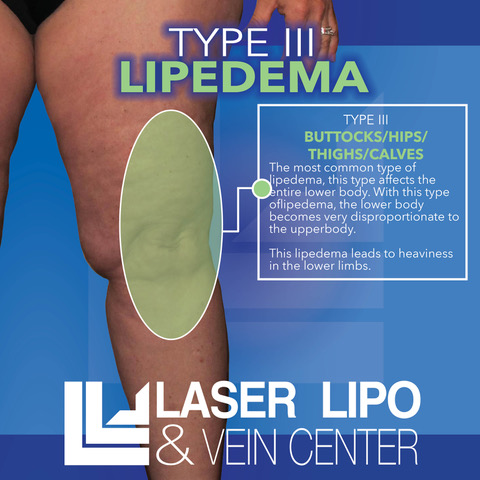 Mayo Clinic Lipedema What Is The Best Advice For Managing Lipedema?