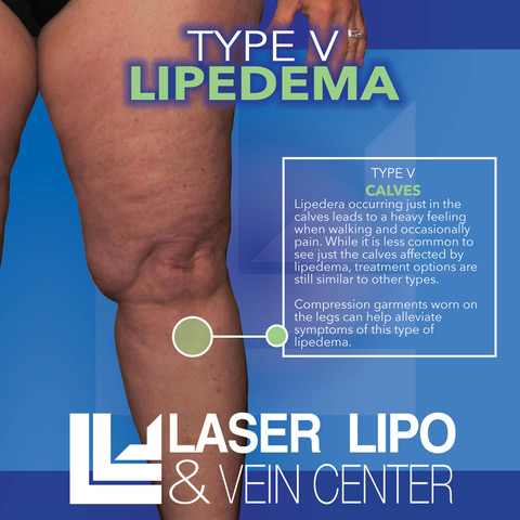 What Is Se 3 Lipedema Treatment - Infoupdate.org
