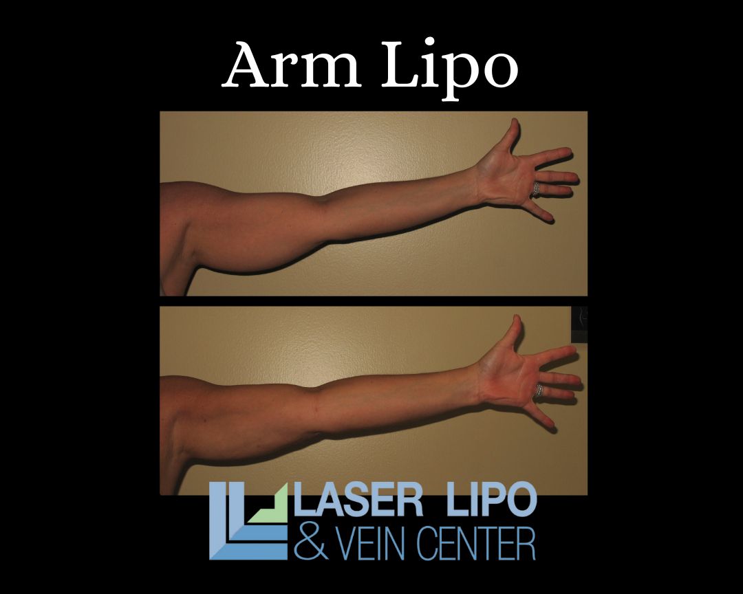 Arm Liposuction St. Louis | Laser Lipo and Vein Center