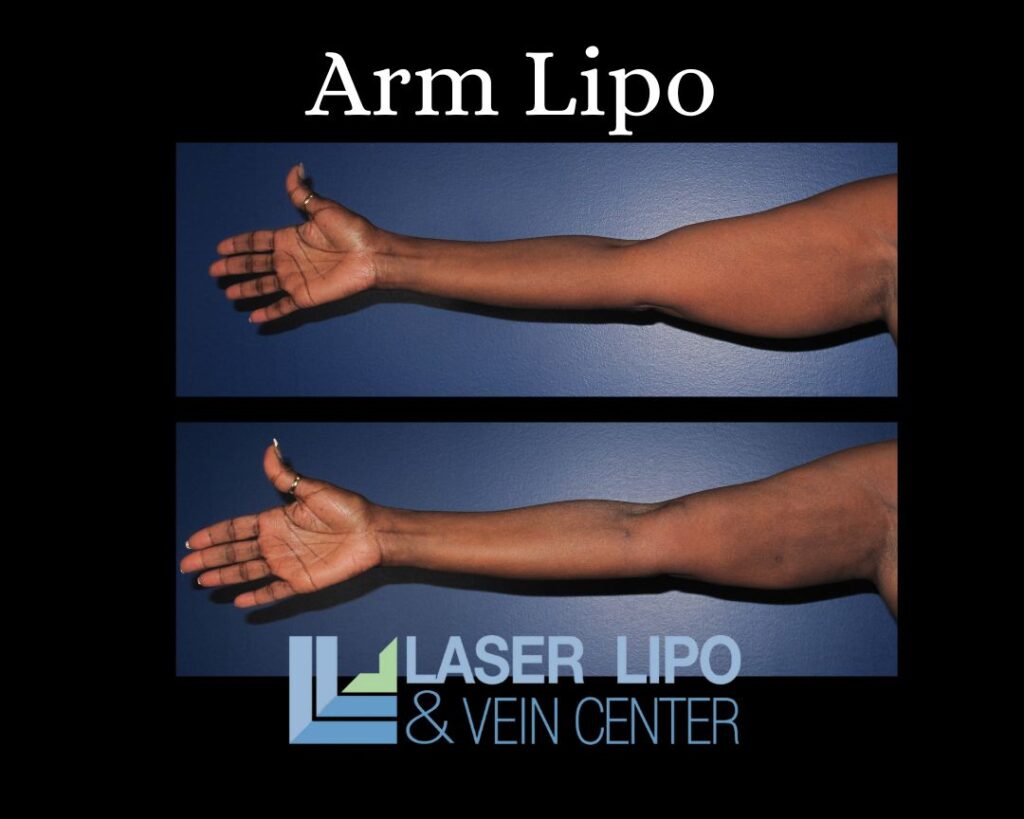 Arm Liposuction St. Louis | Laser Lipo and Vein Center