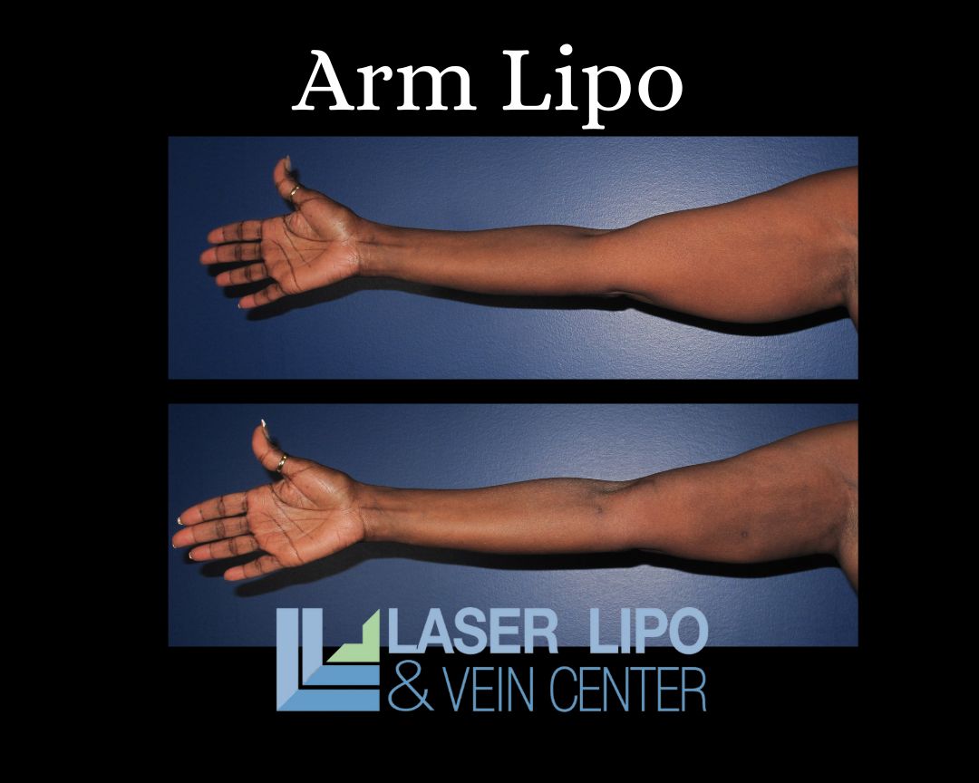 Arm Liposuction St. Louis | Laser Lipo and Vein Center
