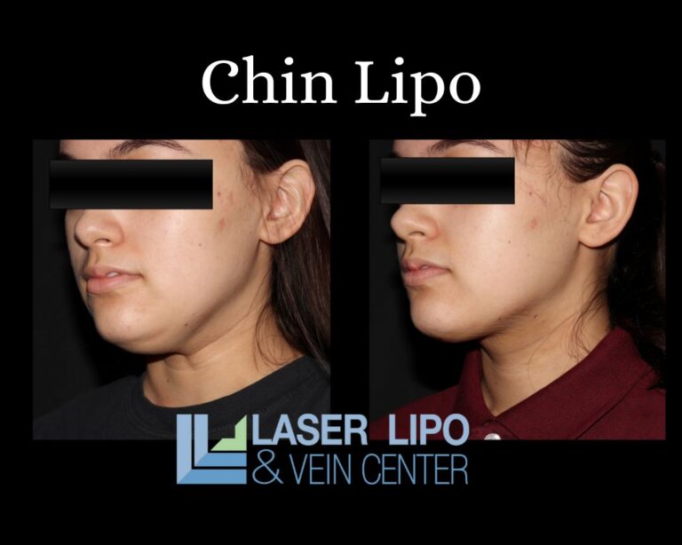 St Louis Cheek, Jowl, and Jawline Liposuction | Laser Lipo and Vein Center