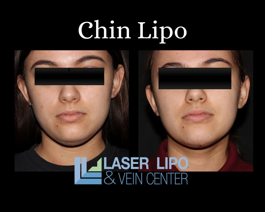 St Louis Cheek, Jowl, and Jawline Liposuction | Laser Lipo and Vein Center