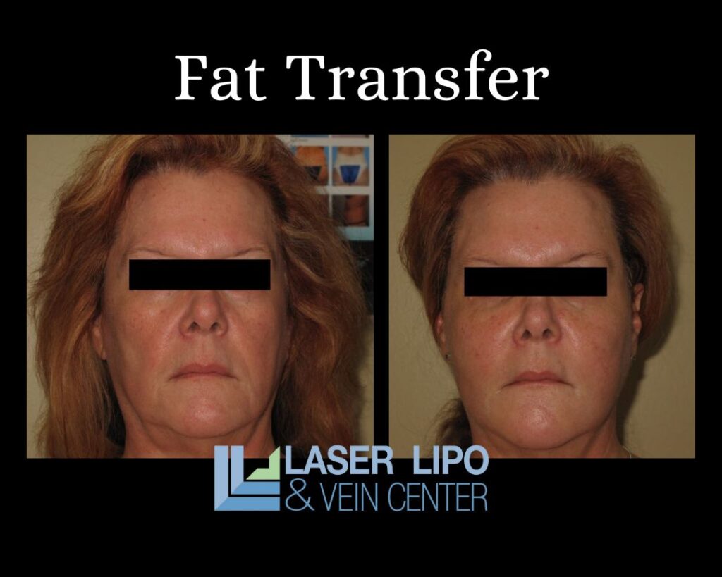 Fat Transfer to Face | Laser Lipo and Veins