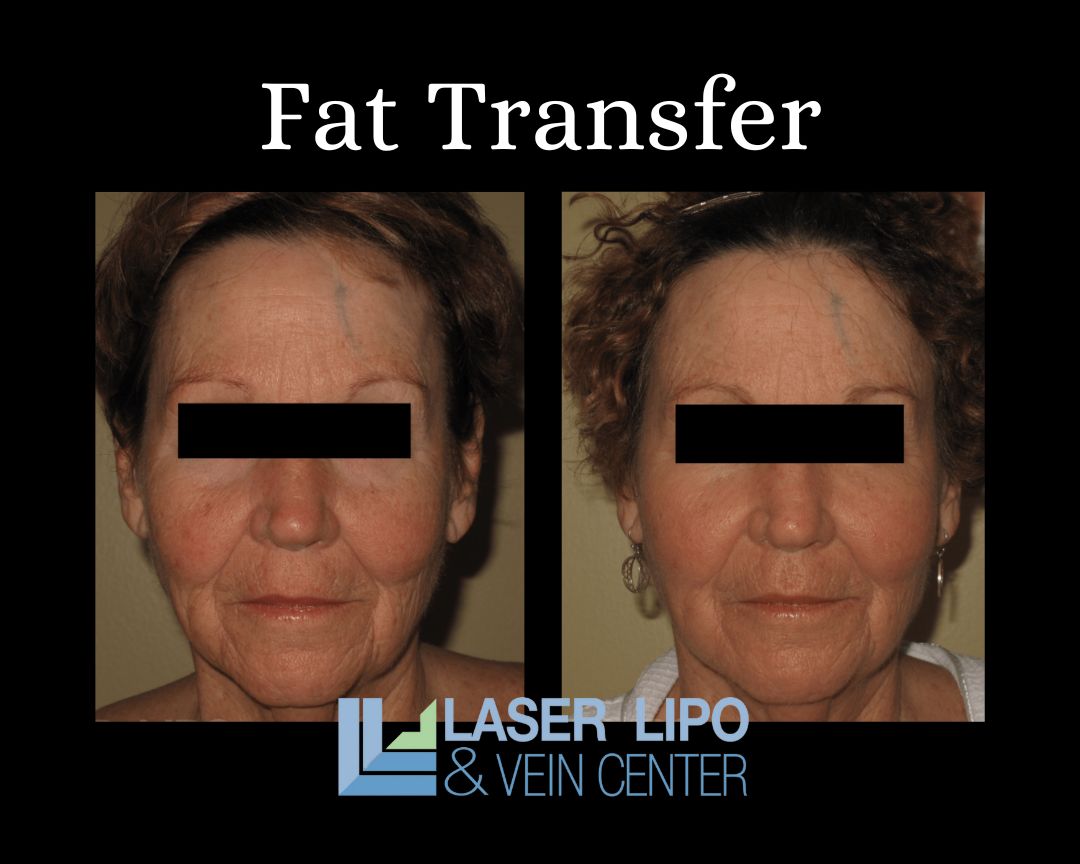 Fat Transfer to Face | Laser Lipo and Veins