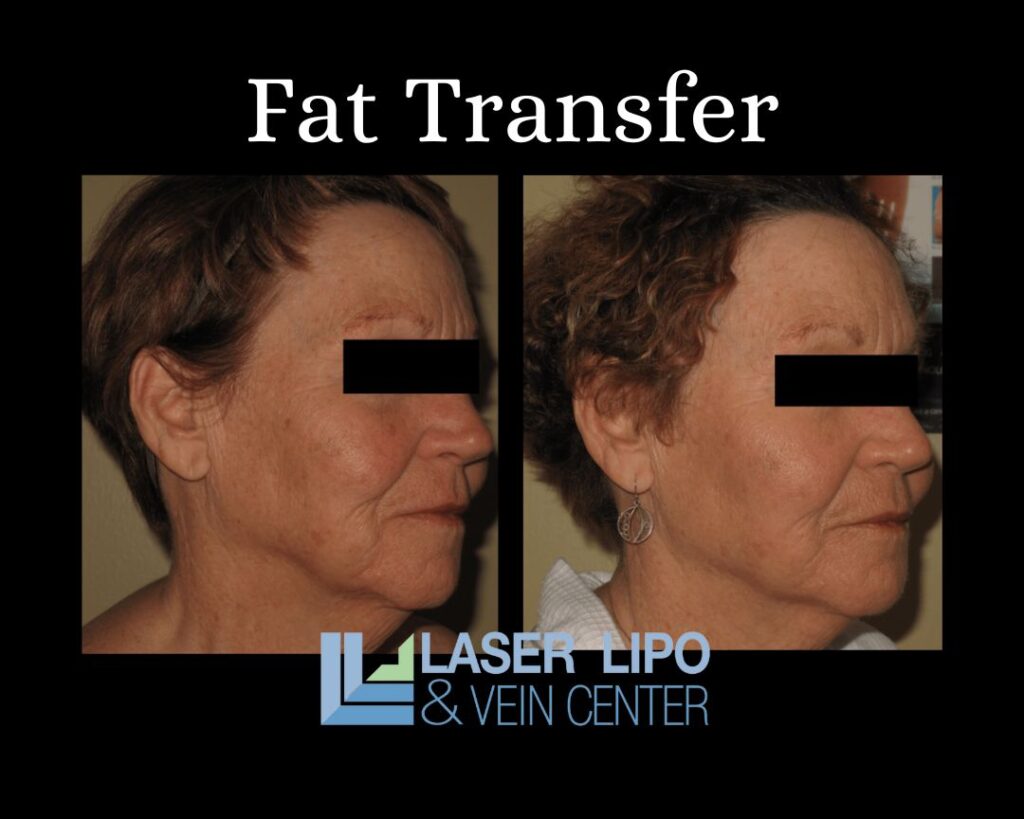 Fat Transfer to Face | Laser Lipo and Veins