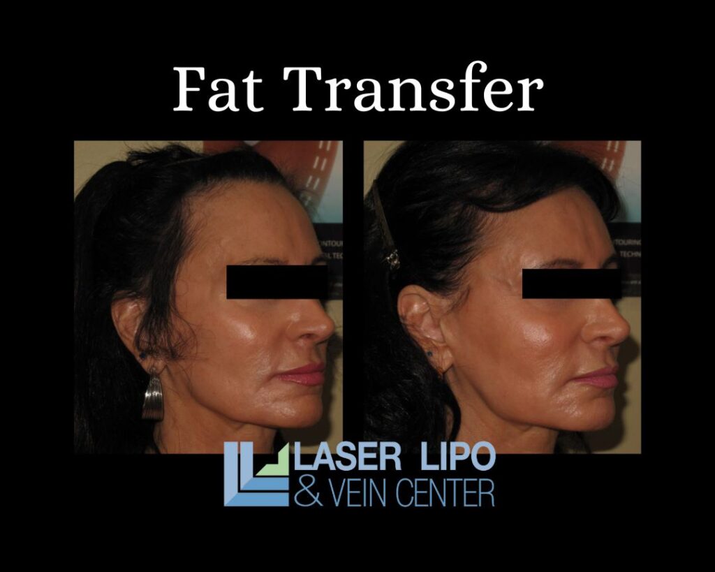 Fat Transfer to Face | Laser Lipo and Veins