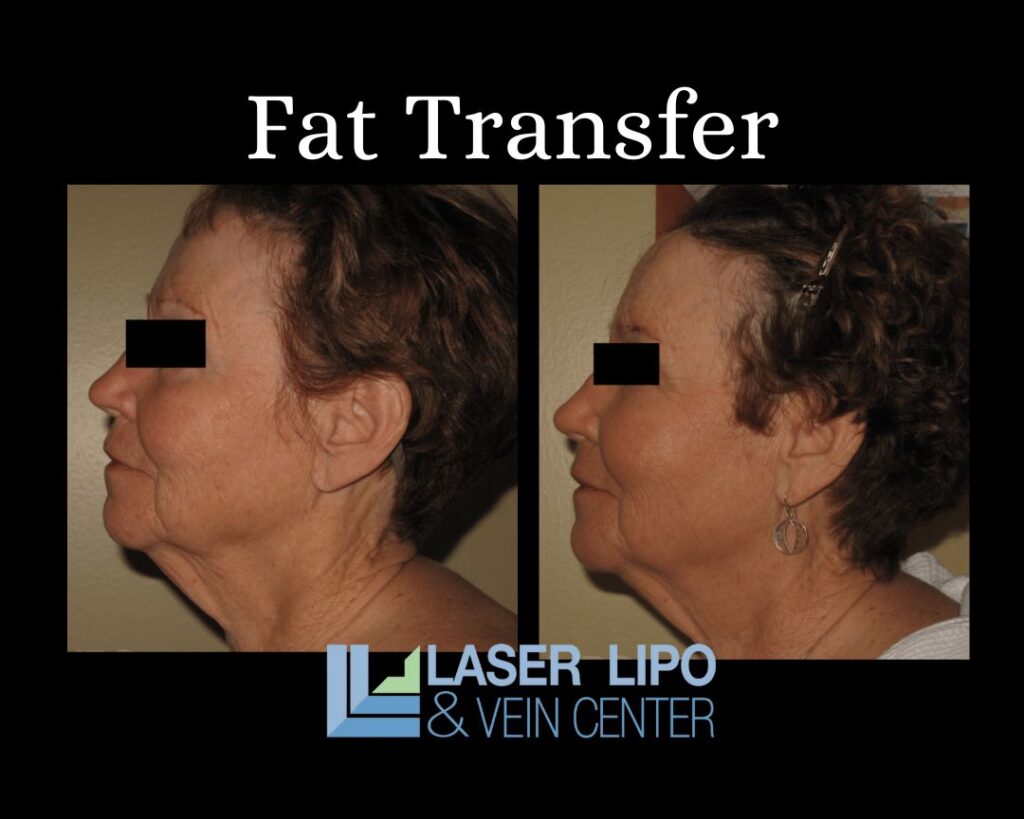 Liposuction Fat Transfer