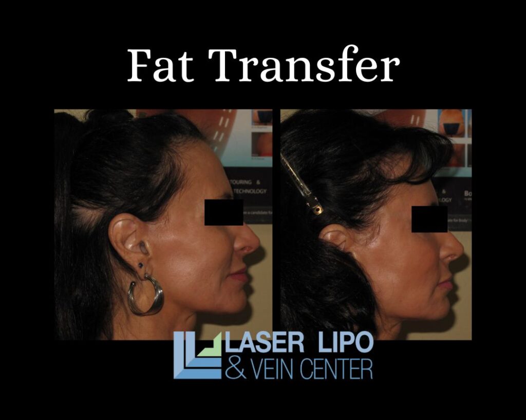 Fat Transfer to Face | Laser Lipo and Veins