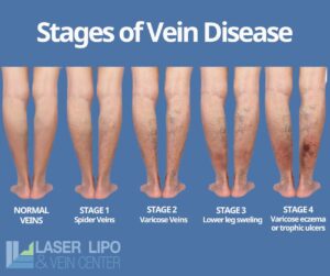 Understanding the Importance of Vein Health | Laser Lipo and Veins