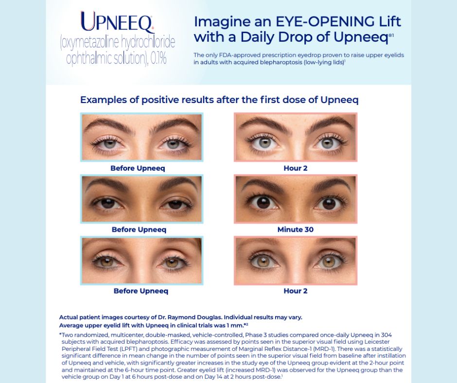 Upneeq | The Innovative Droopy Eyelid Treatment | Laser Lipo and Veins