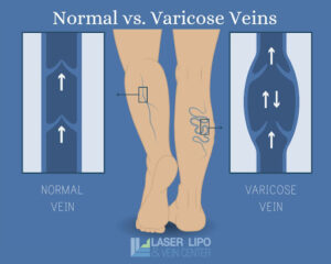 Varicose Veins Treatment and Removal St Louis | Vein Treatment St Louis
